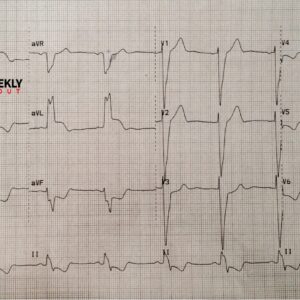 Barcelona criteria – ECG Weekly
