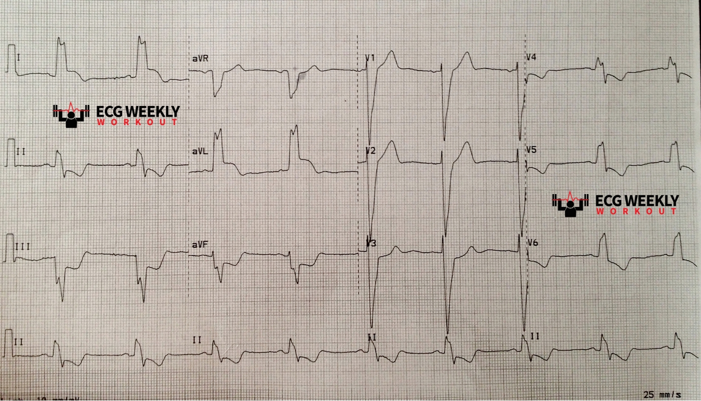 Stat Ecg Diagnoses Left Bundle Branch Block Lbbb Basics And Expected Findings With A Focus On