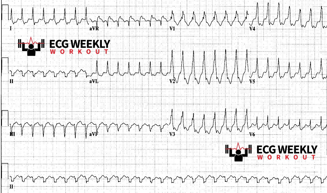 Literature Review: pearls and pitfalls in the ECG diagnosis for ventricular tachycardia – ECG Weekly