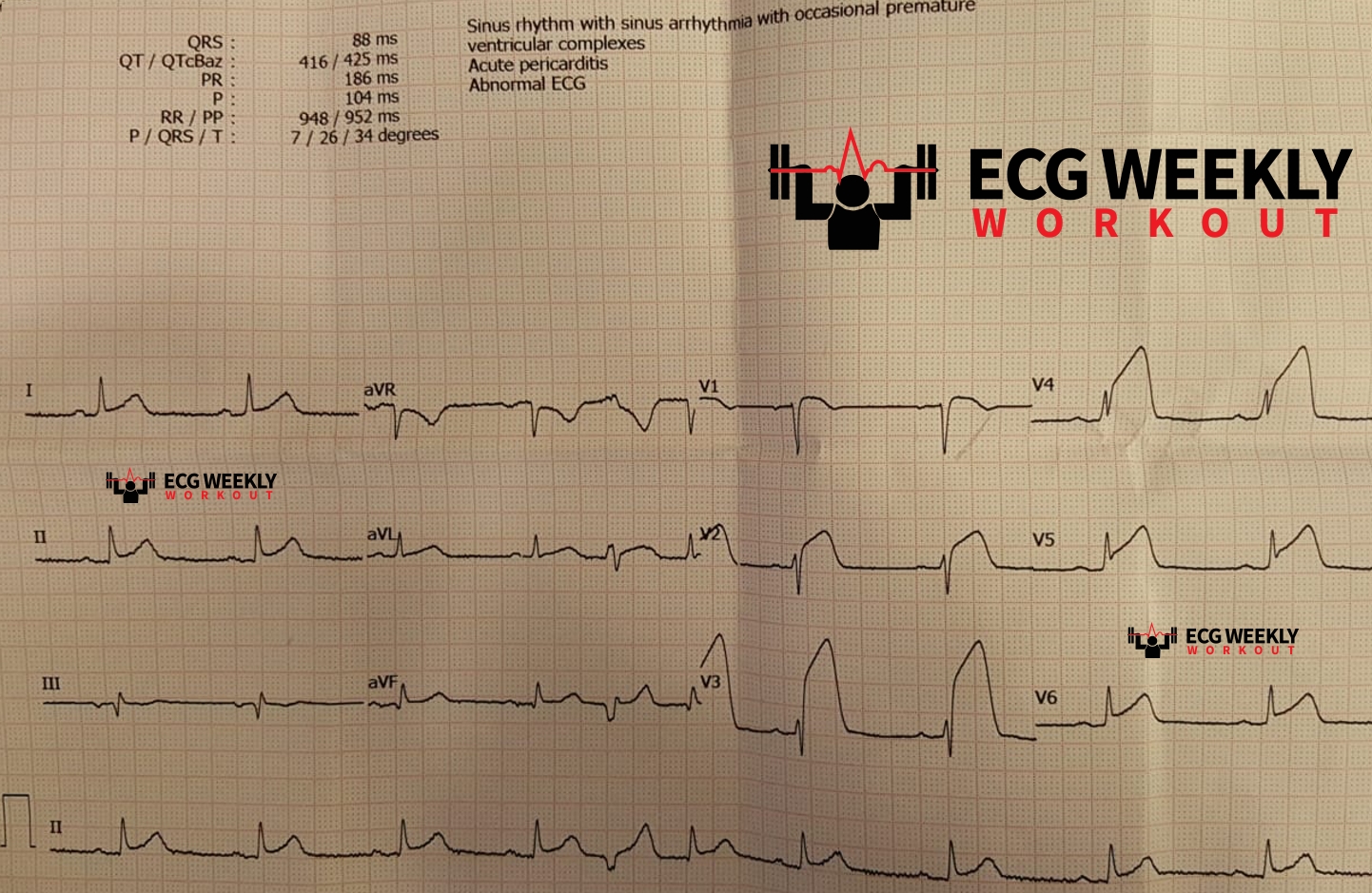 Bifascicular blocks, trifascicular blocks, electrocardiographic ...