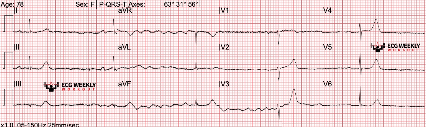 Bifascicular blocks, BRASH syndrome, and so much more! – ECG Weekly
