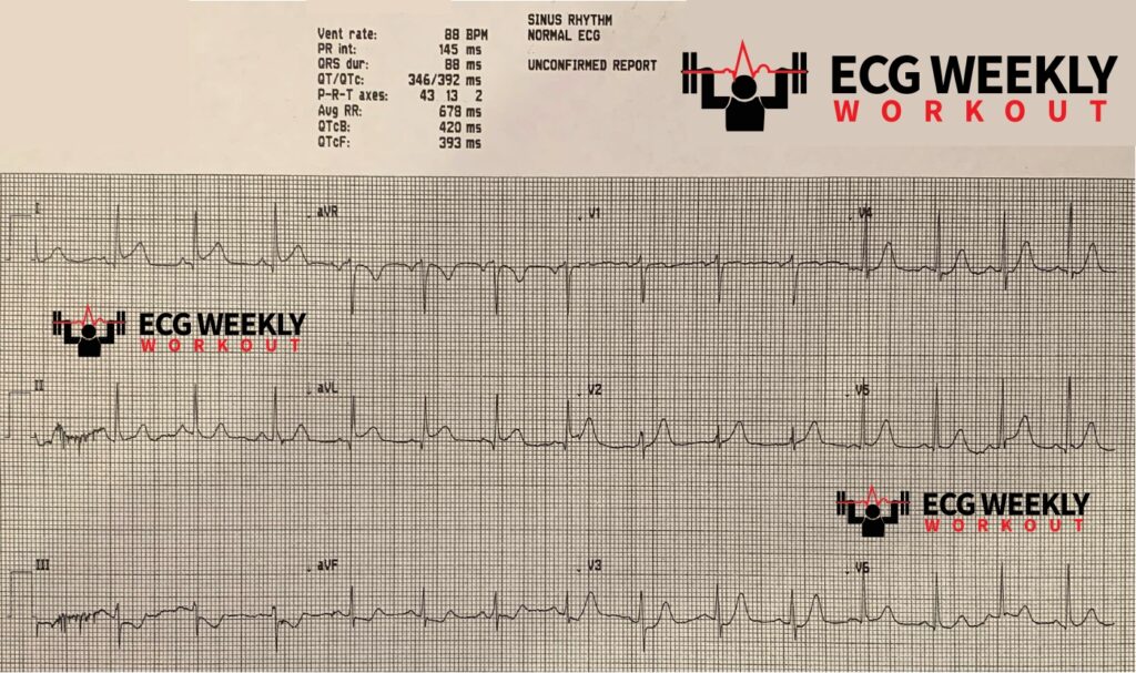 Potpourri of cases: BRASH syndrome, the ECG findings in patients of digoxin, and so much more ...