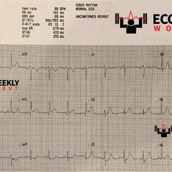 Pericarditis – ECG Weekly