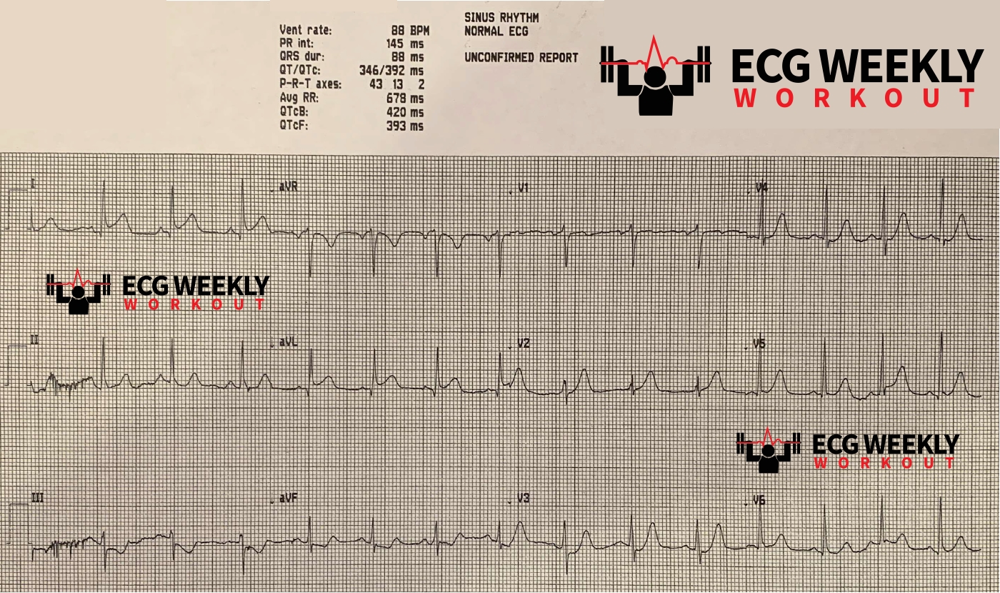 Potpourri of cases: BRASH syndrome, the ECG findings in patients of digoxin, and so much more ...