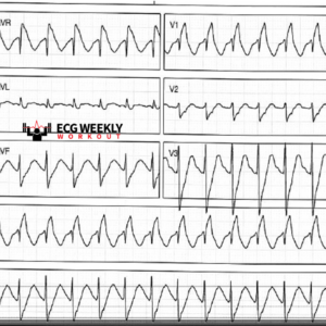 Right Axis Deviation – ECG Weekly