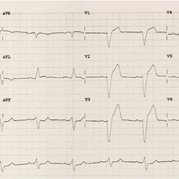 Barcelona criteria – ECG Weekly