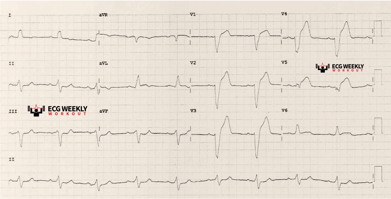 ECG Basics and Fundamentals: the basics of left bundle branch block ...
