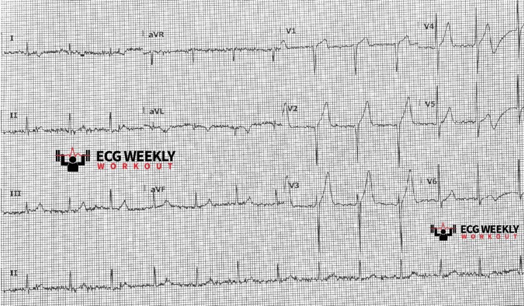 Literature Review: mechanisms of acute coronary syndromes (ACS) and the ...
