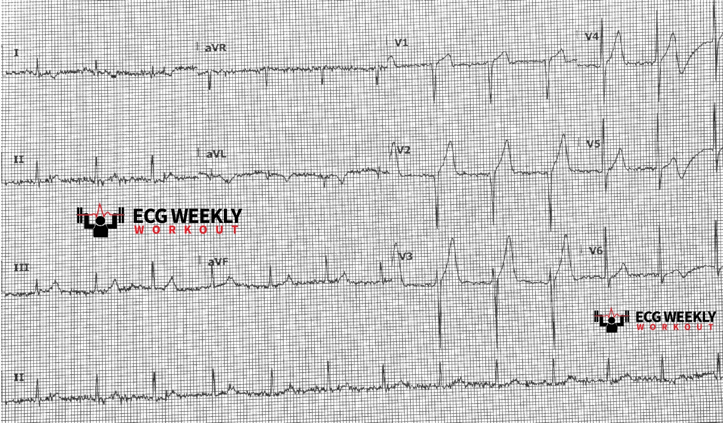 Literature Review: mechanisms of acute coronary syndromes (ACS) and the ...