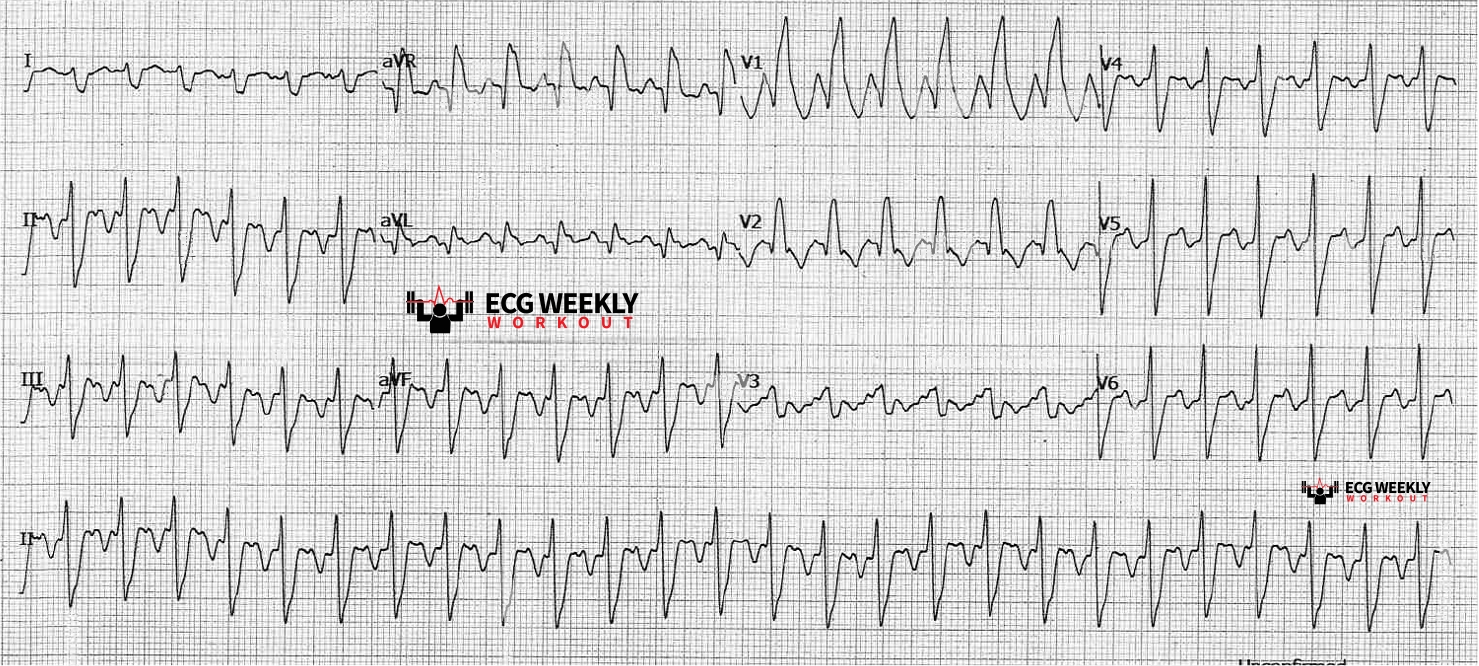 Wide Complex Tachycardias: What is the Lewis lead and how you can use ...