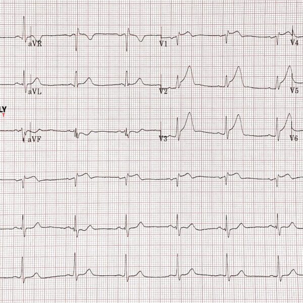 pulmonary hypertension – ECG Weekly