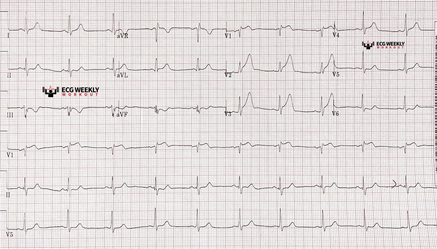 STAT ECG Diagnoses: is this ST segment elevation due to early ...