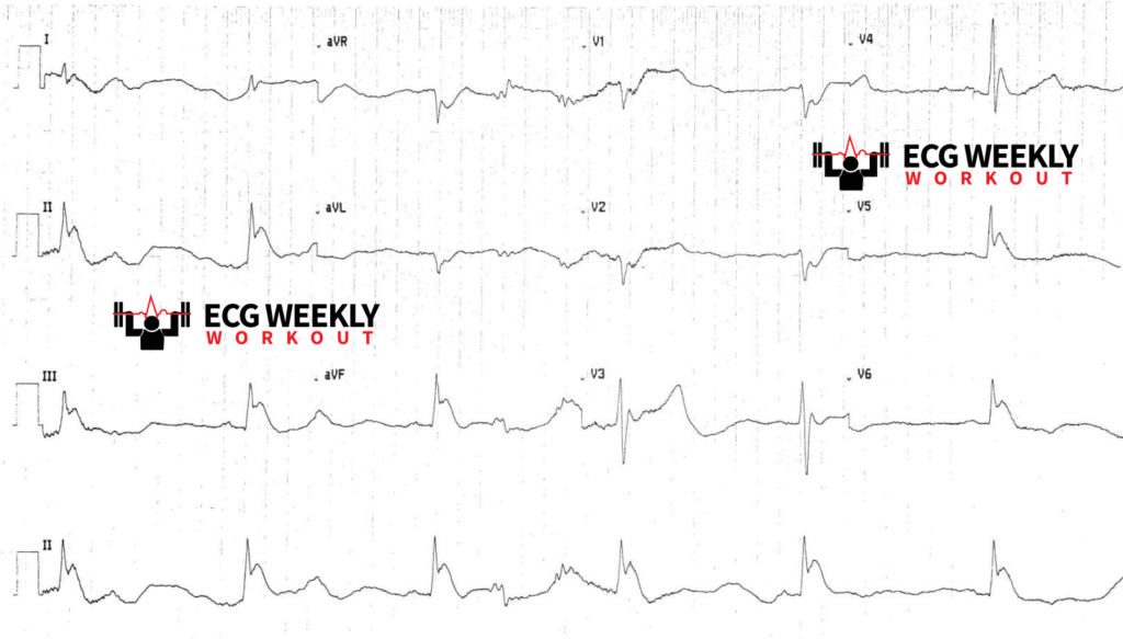 STAT ECG Diagnoses: ECG findings that can help you clinch the diagnosis in patients with altered ...