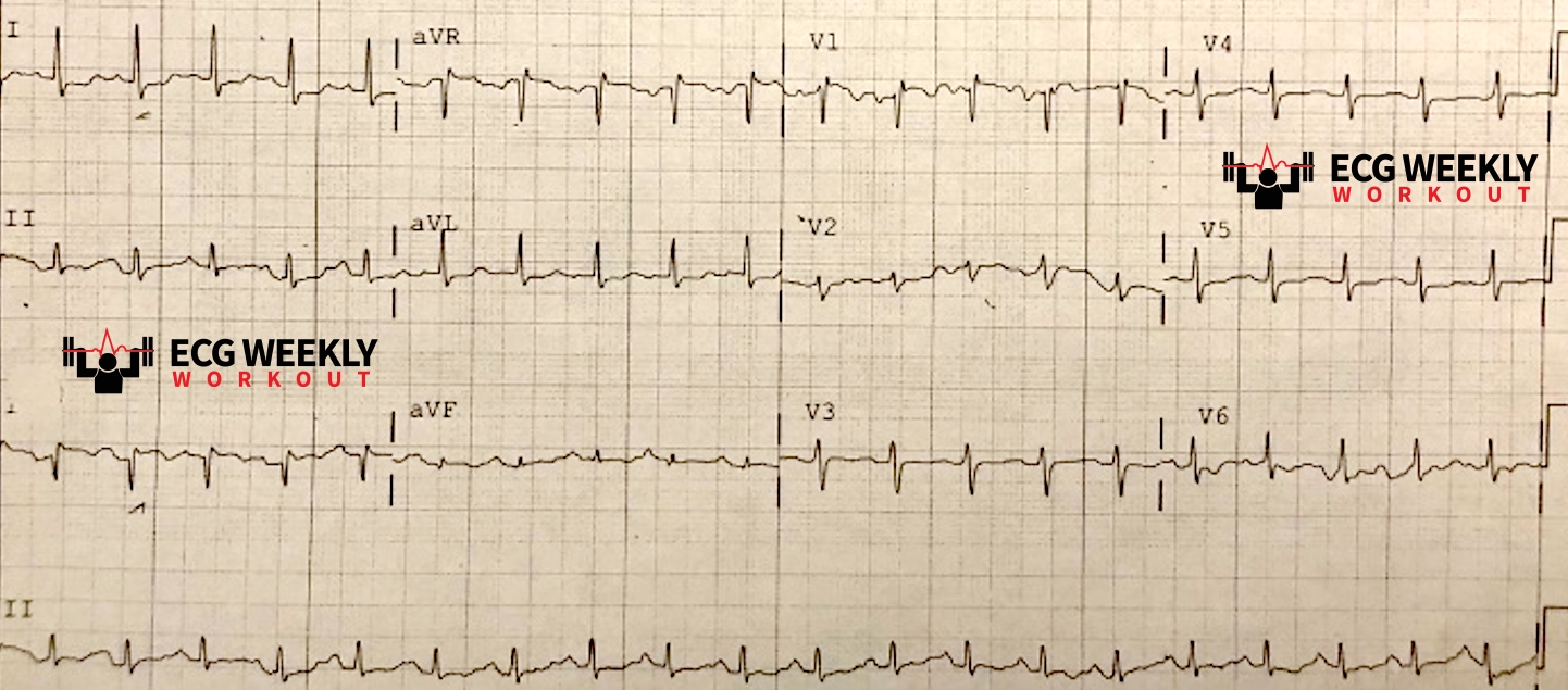 Differential Diagnoses: the many causes of ST segment elevation – ECG ...