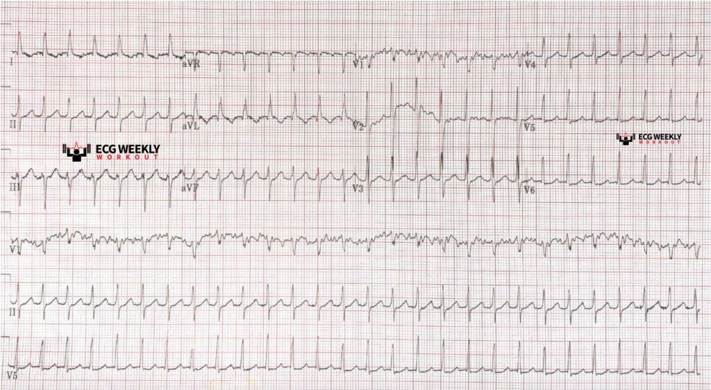 Narrow Complex Tachycardia: the maximum achievable sinus heart rate – ECG Weekly