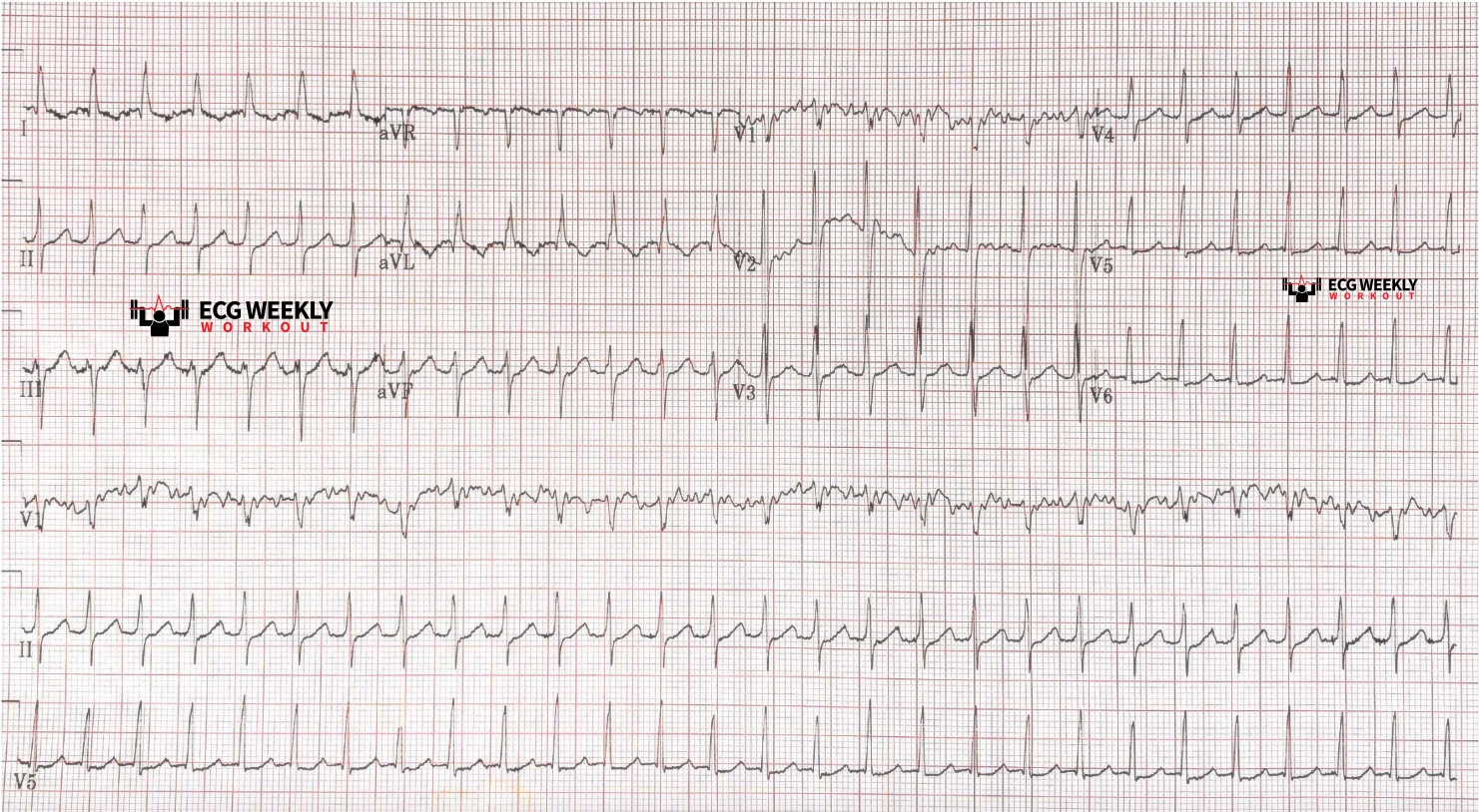Narrow Complex Tachycardia: the maximum achievable sinus heart rate ...