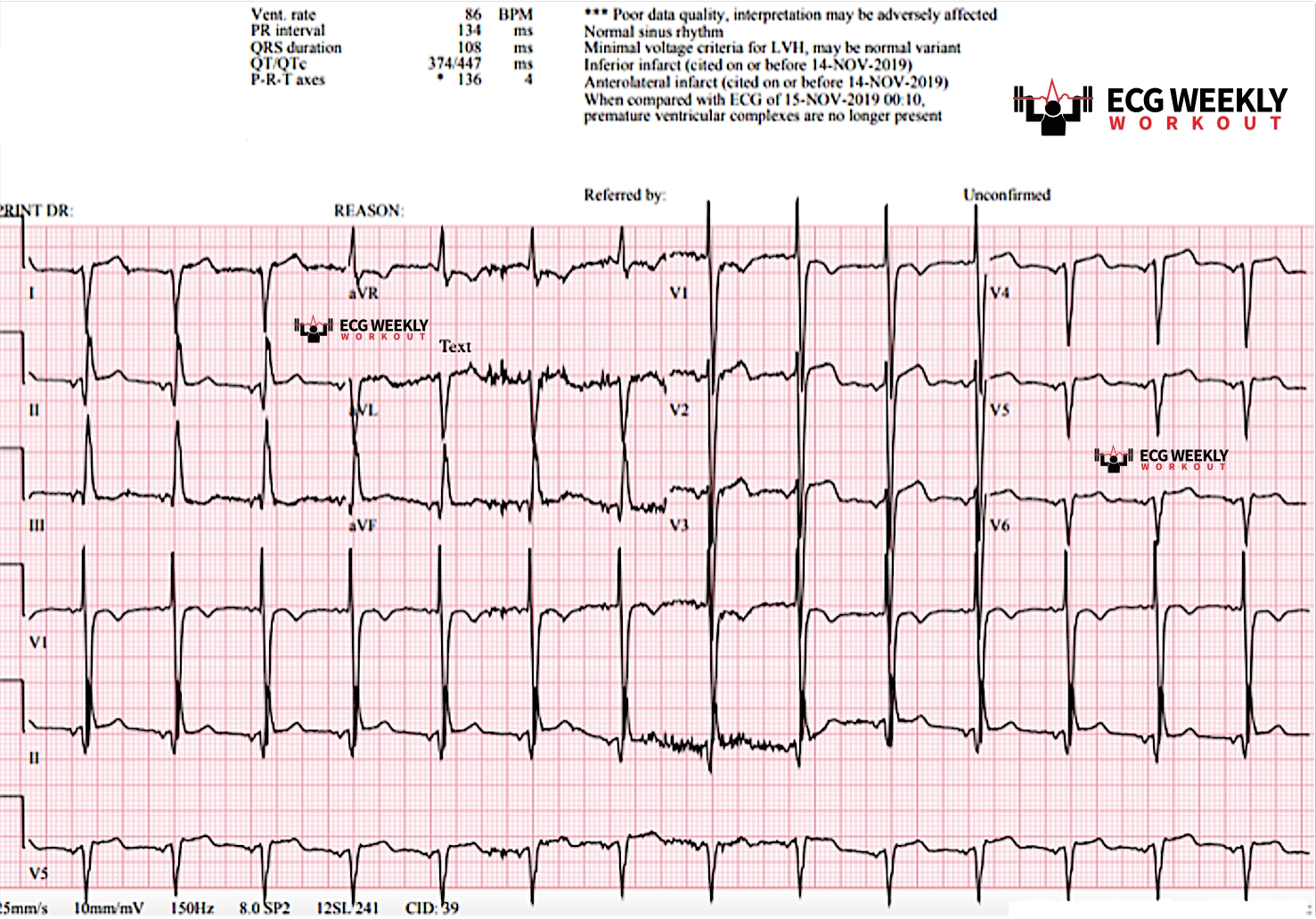 STAT ECG Diagnoses: the right way to think about right axis deviation – ECG Weekly