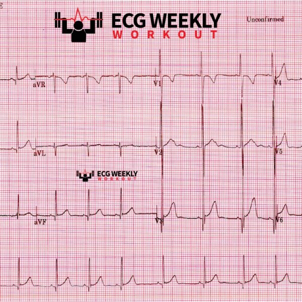 Hypertrophic obstructive cardiomyopathy – ECG Weekly