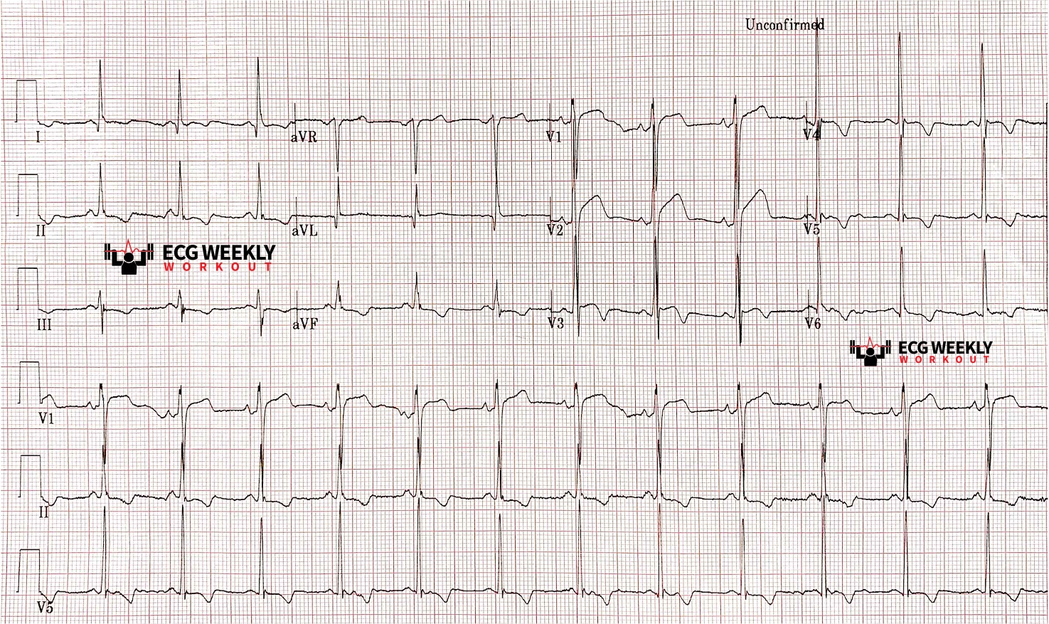 Differential Diagnoses: T wave inversions and a discussion about ...