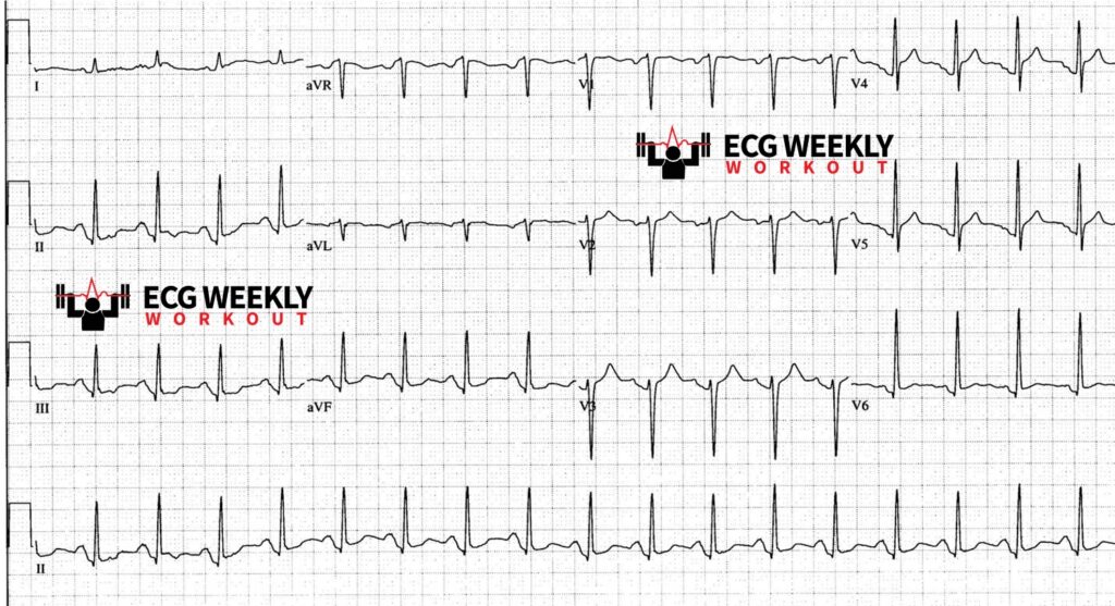 ECG Basics and Fundamentals: the isoelectric baseline used to evaluate ...