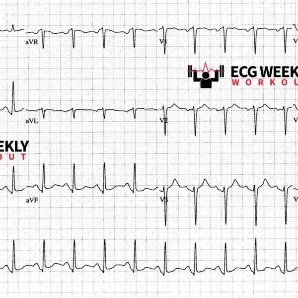 PR segment – ECG Weekly