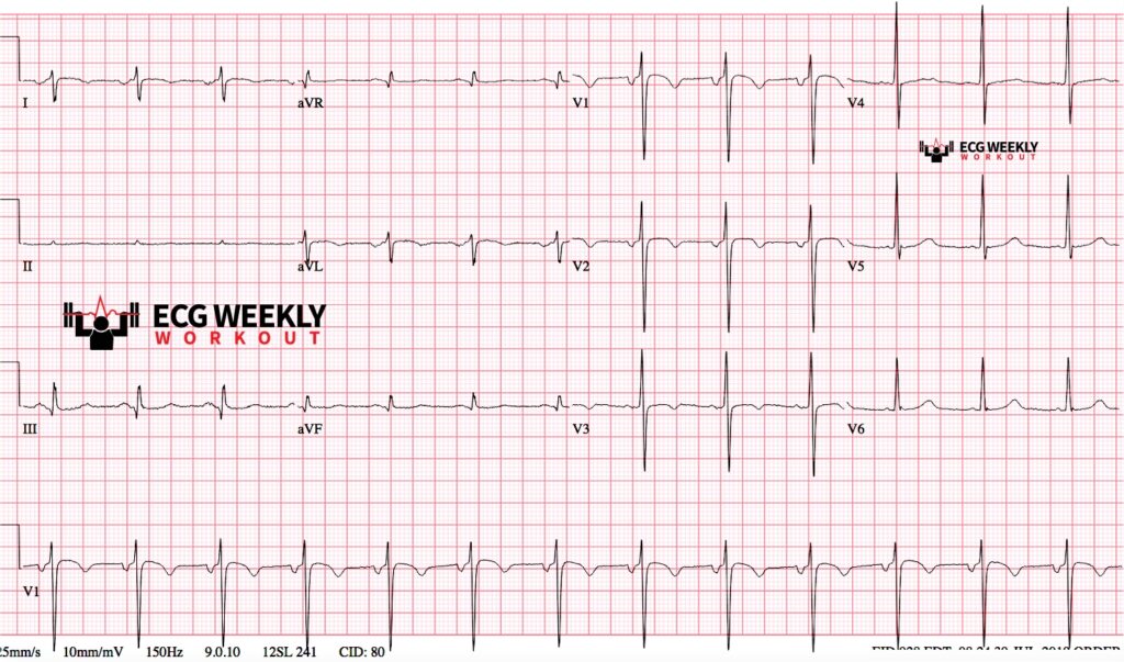 ECG Basics and Fundamentals: limb lead reversal – ECG Weekly