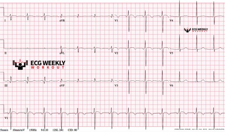 ECG Basics and Fundamentals: limb lead reversal – ECG Weekly