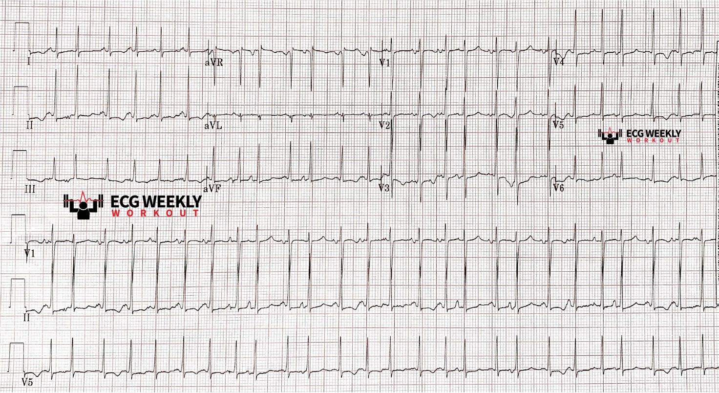 STAT ECG Diagnoses: when to cardiovert narrrow complex irregular tachycardias – ECG Weekly