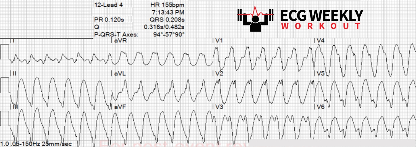 STAT ECG Diagnoses: knowing what you are looking for when differentiating the different types of ...