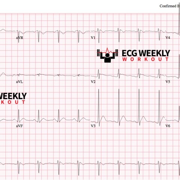 Hypercalcemia – ECG Weekly