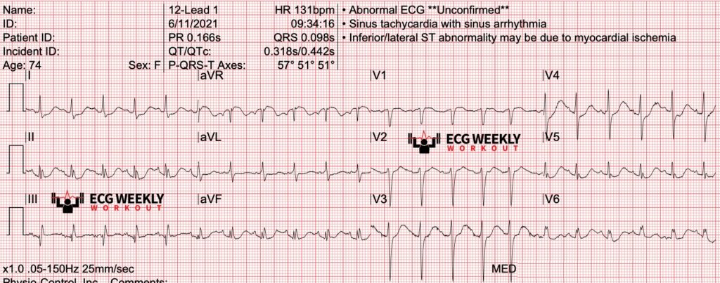 5 more challenging EMS cases to help you test your emergency ECG ...