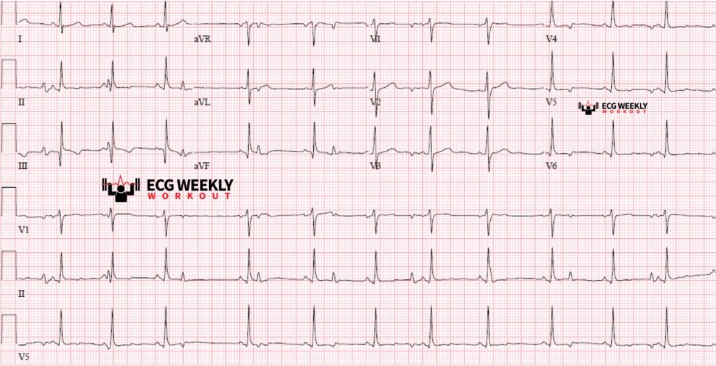 Palpitations with extra beats, a discussion on atrial parasystole – ECG ...