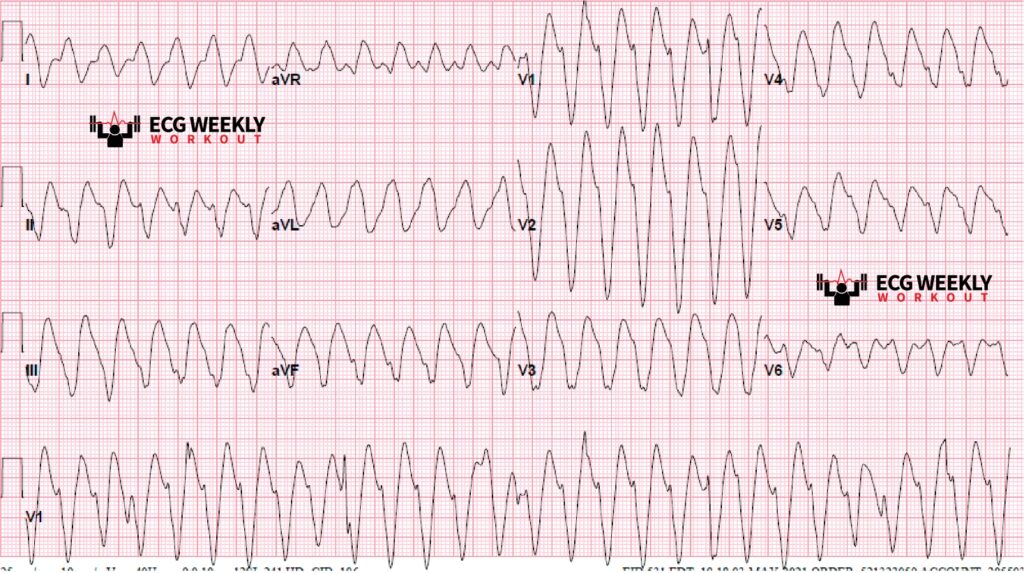 STAT ECG Diagnoses: a review of the differentials to consider when ...