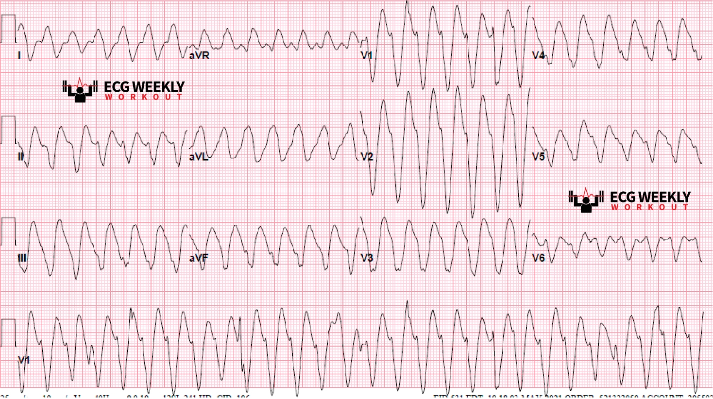 STAT ECG Diagnoses: a review of the differentials to consider when ...