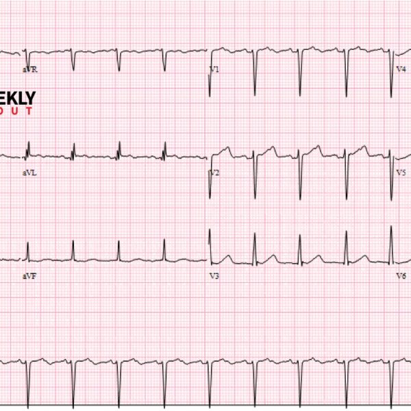 Pulmonary Embolism – ECG Weekly