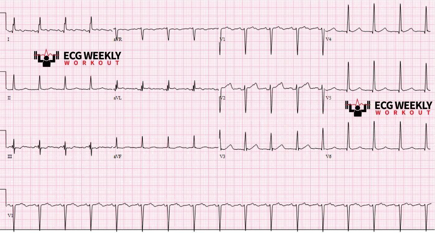 Potpourri of cases: the most common ECG findings in pulmonary embolism ...