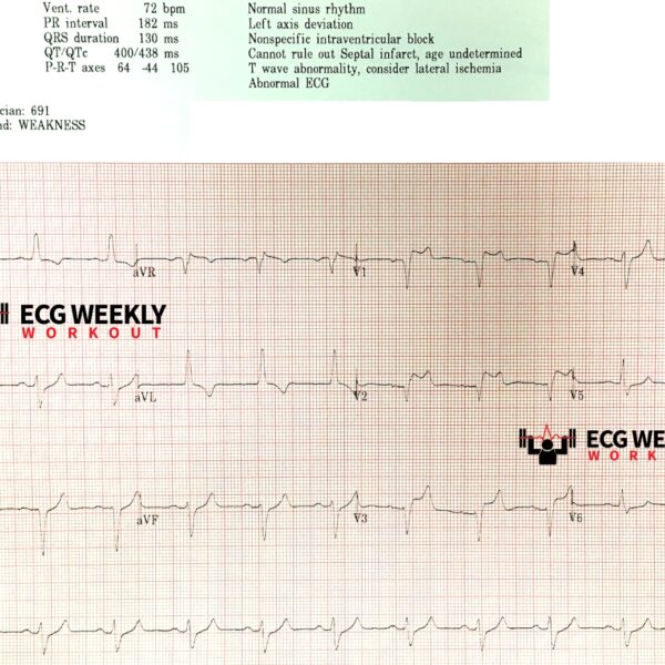 Pulmonary Embolism – ECG Weekly