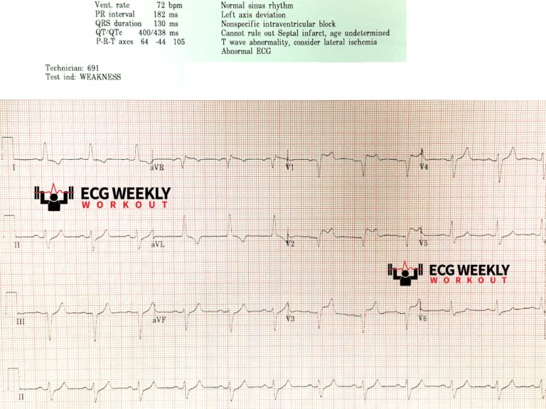 STAT ECG Diagnoses: the differentials to consider when dealing with ST segment elevation and an ...