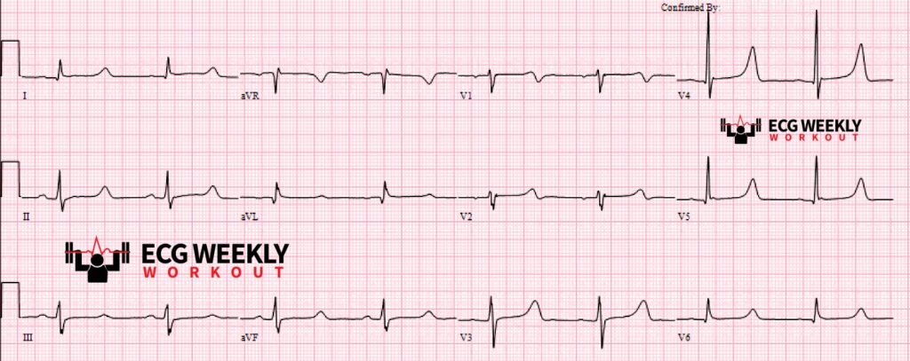 Differential Diagnoses: causes of prolonged QTc intervals with long ST ...