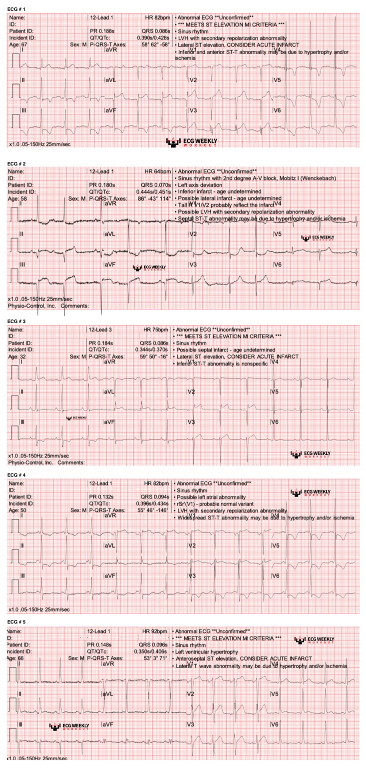 STAT ECG Diagnoses: the ECG in patients with significant left ...