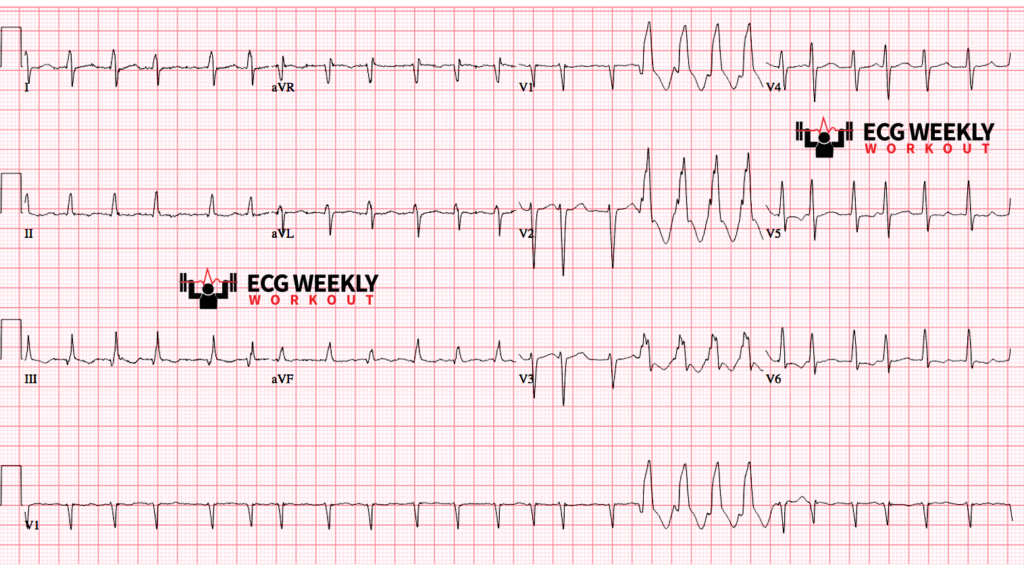 STAT ECG Diagnoses: what exactly is Ashman phenomenon and why does it ...