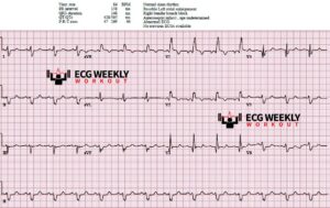 STAT ECG Diagnoses: any ST segment elevation in patients with right bundle branch blocks (RBBB ...