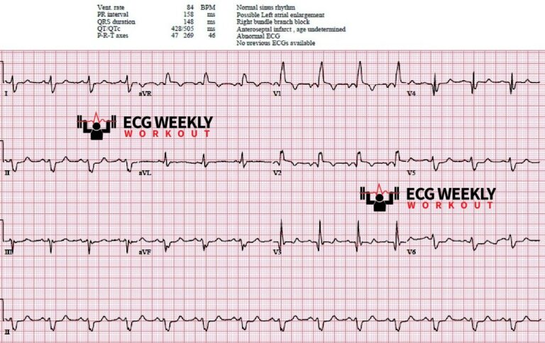 STAT ECG Diagnoses: any ST segment elevation in patients with right bundle branch blocks (RBBB ...