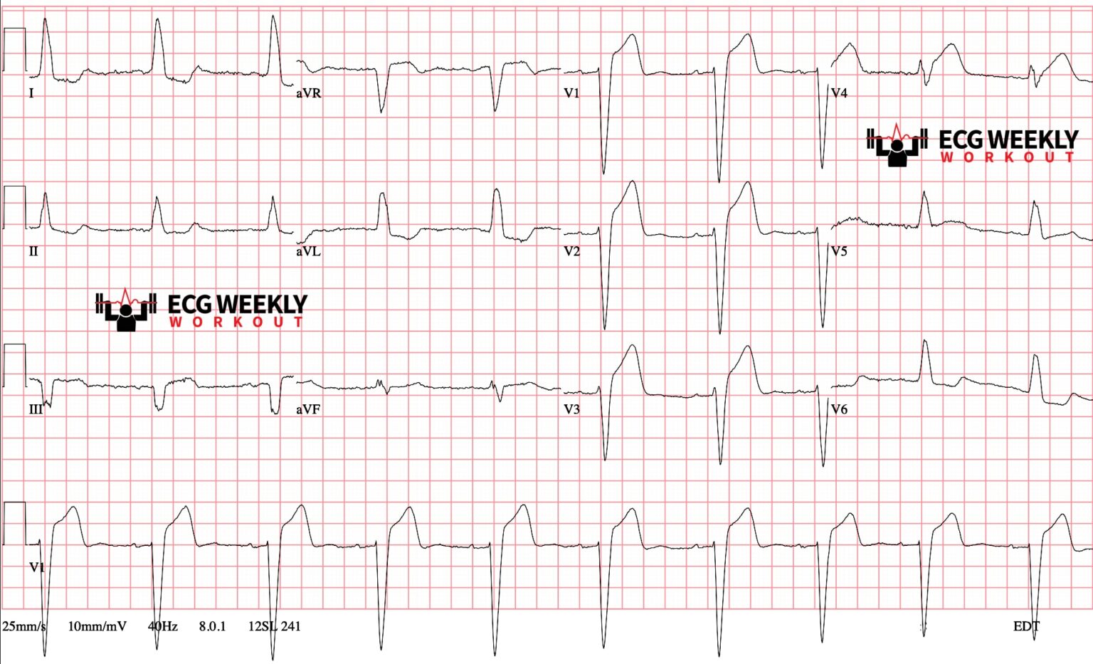 STAT ECG Diagnoses: the basics of left bundle branch blocks (LBBB) and ...