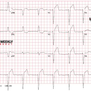 Sgarbossa – ECG Weekly
