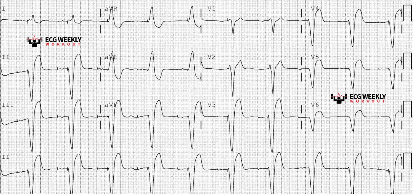 Literature Review: diagnosis of acute coronary occlusion myocardial ...