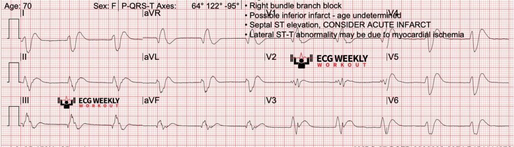 STAT ECG Diagnoses: identification of acute coronary occlusion ...