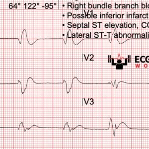 STE in aVR – ECG Weekly
