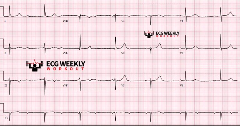 Bradyarrhythmias: differentiation of Mobitz and other atrioventricular ...
