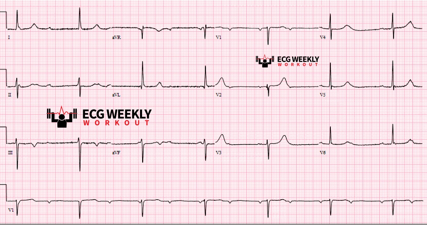 Bradyarrhythmias: differentiation of Mobitz and other atrioventricular ...
